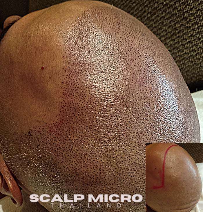 SMP MEN - Scalp Micro Thailand