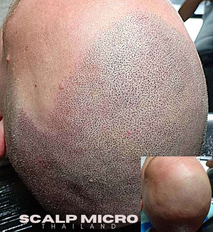 SMP MEN - Scalp Micro Thailand